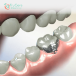 A Simple Guide To Know Everything About Molar Bands – TruCare Dentistry