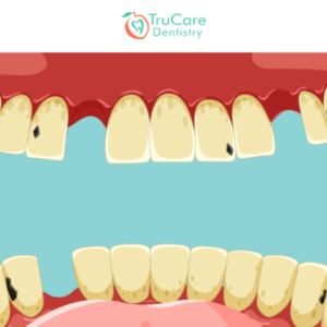 Anodontia 101: Everything You Need to Know About the Rare Condition ...