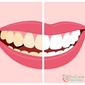 Tooth Discoloration: Common Causes of Tooth Discoloration – TruCare ...