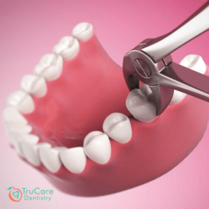 Complications in Tooth Extraction – TruCare Dentistry