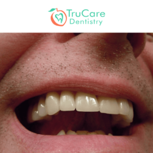 Dry Socket: Everything You Need To Know – TruCare Dentistry