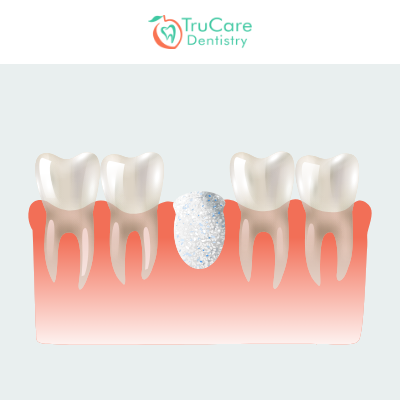 Do sharp bone fragments in the gum need immediate removal? – TruCare ...