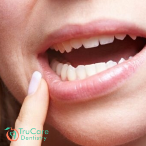 How to strengthen loose teeth: Causes and Remedies – TruCare Dentistry