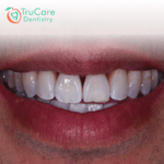 Here’s What You Should Know About Black Triangles Between Your Teeth