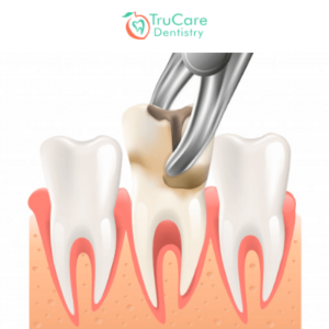 Save Your Tooth Or Pull It: Which One Is Ideal? – TruCare Dentistry