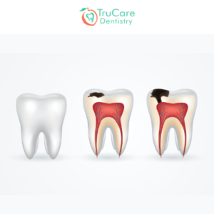 The Stages of Tooth Decay and How to Prevent It? – TruCare Dentistry