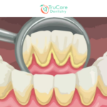 What Is a Calculus Bridge? Know Everything - TruCare Dentistry Roswell